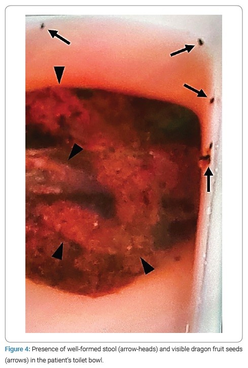 Стул красного цвета или кровь в кале после приема драгонфрута (питайи ...